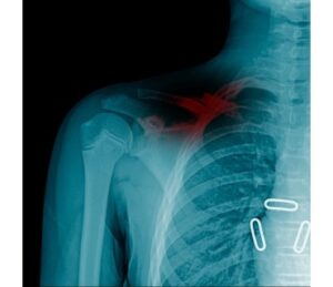 Stellate Ganglion Injections - Centerpaincontrol